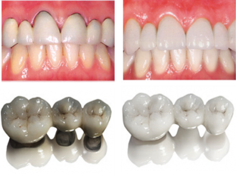 ¿Sabe de qué material están hechas las coronas para sus implantes ...