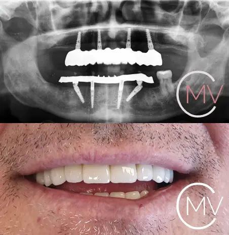 All on four - Unidad Dental y Maxilofacial - Clínica Marta Vallés